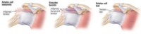 Rotator Cuff Tear | Orthopedic Doctors in Greater Grand Rapids, MI